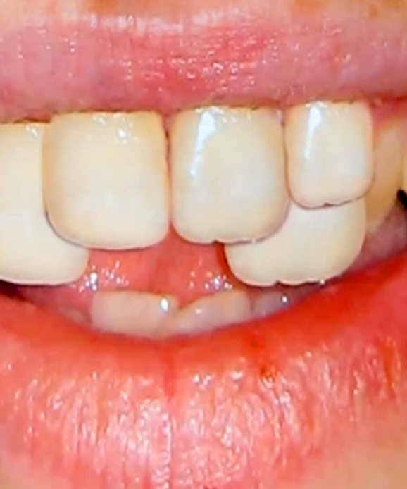 Gigi tidak Rapi? Ketahui Cara Rapikan Gigi