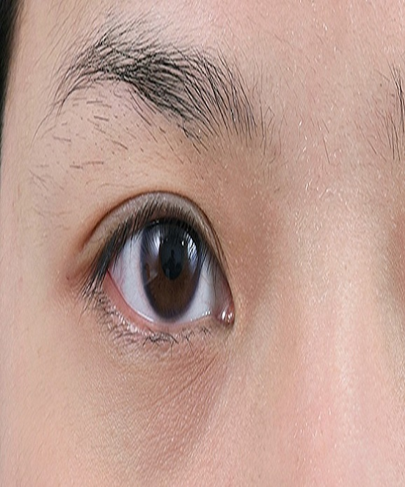 Sudut mata sempit berikut cara mengatasi mata sipit sebelah dengan ...