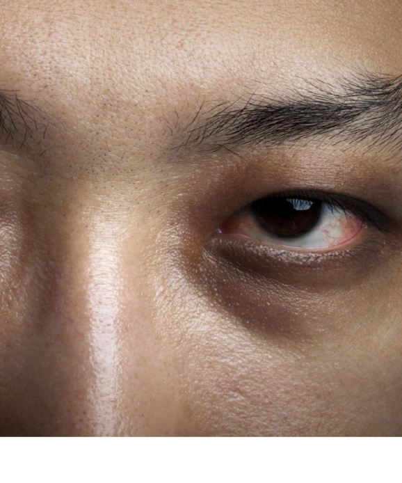 Cara Mengatasi Mata Panda Instan, Aman dan Efektif, Coba Treatment Ini Aja!