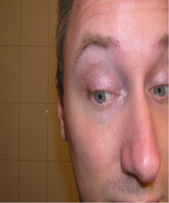 Mata Sayu Tak Bisa dicegah, Atas dengan Prosedur Bedah Plastik Ini!